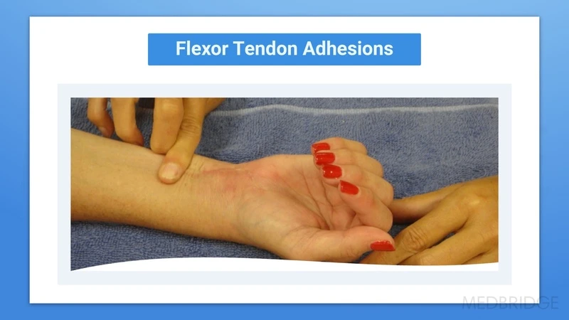 Best Practice for Flexor Tendon Rehabilitation | Medbridge