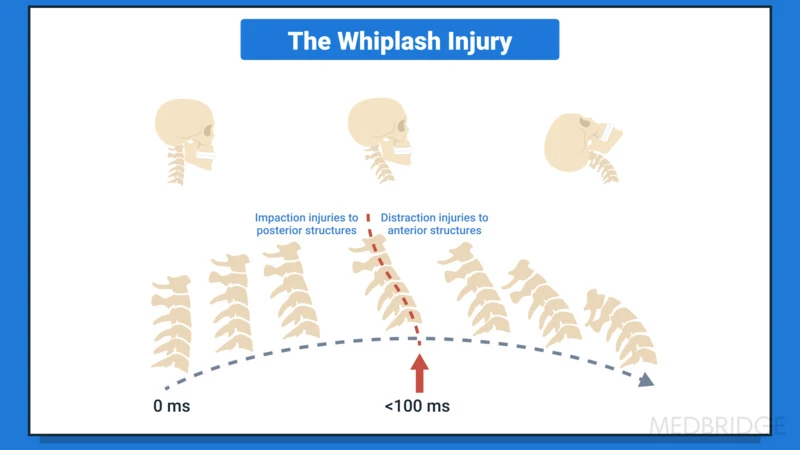 Whiplash-Associated Disorders: Evidence-Based Practice | Medbridge