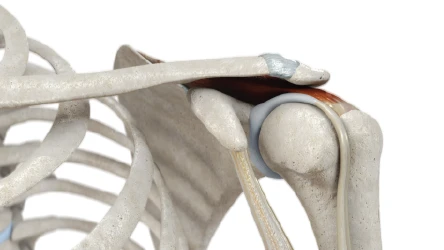 Differential Diagnosis: Superior Labral Anterior to Posterior (SLAP ...